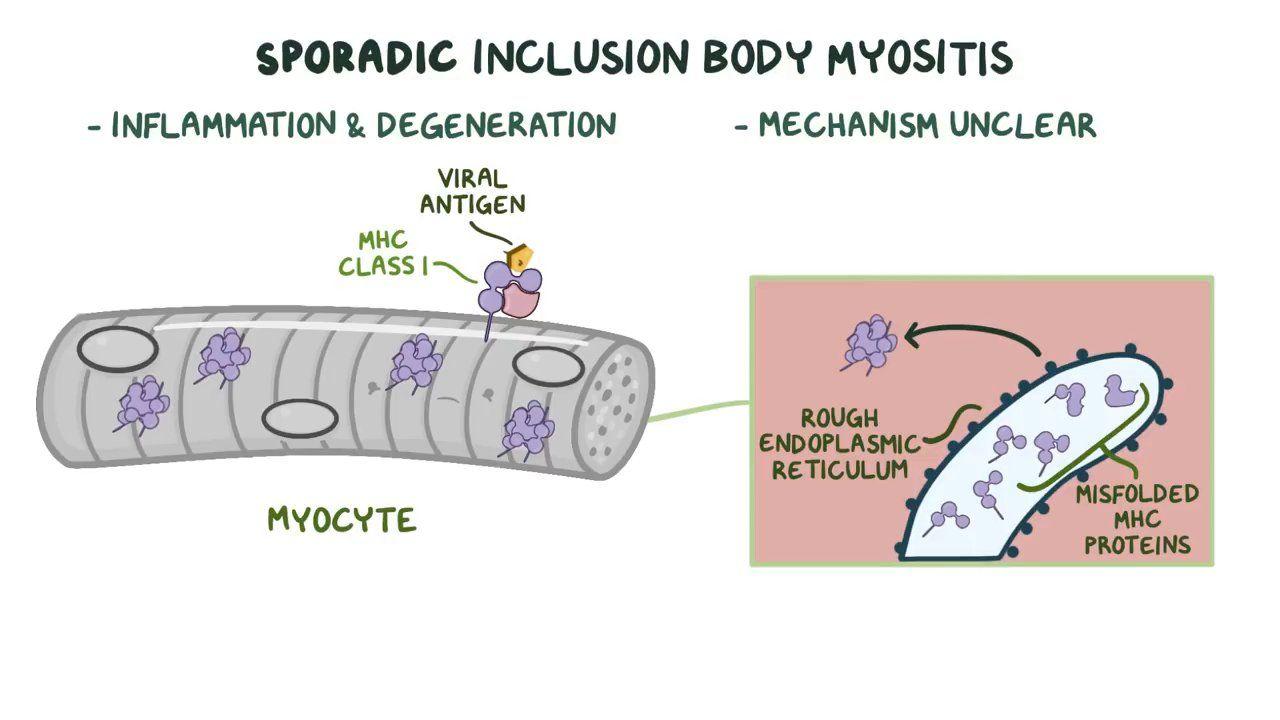 Inclusion body myopathy: Video, Anatomy & Definition | Osmosis