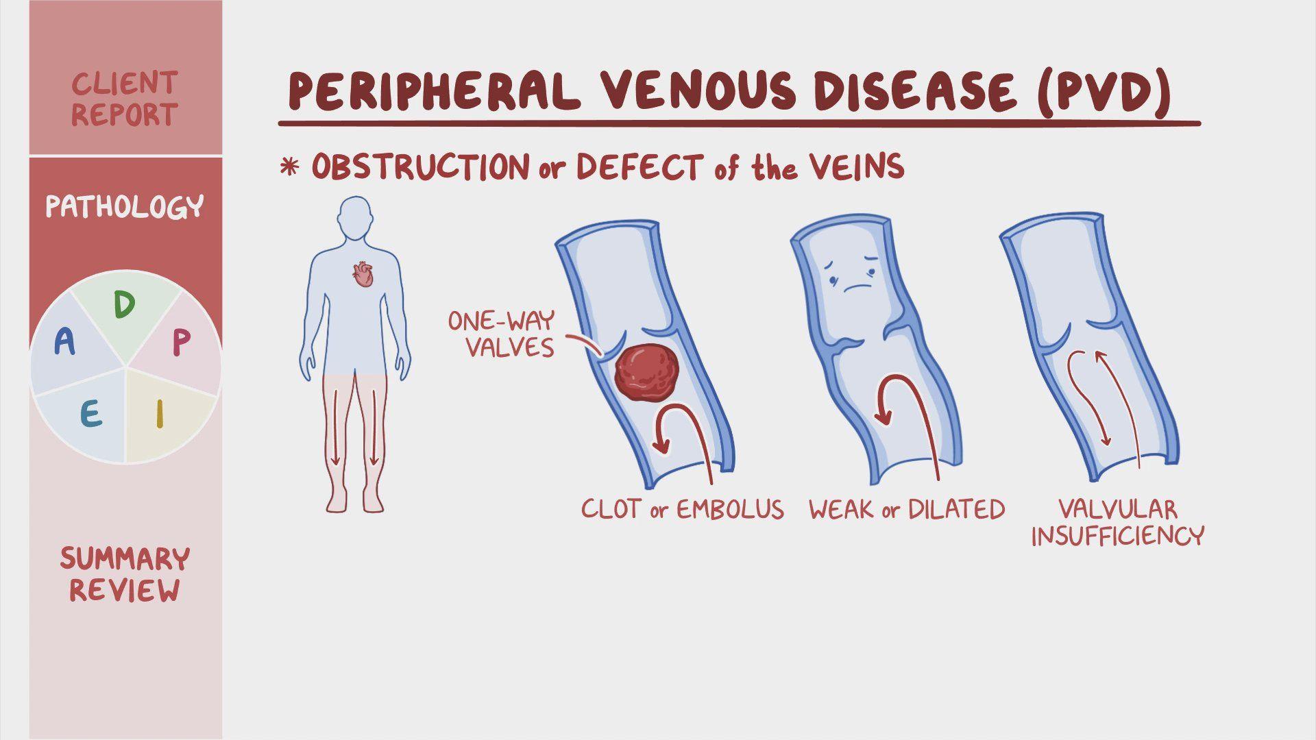 Peripheral venous disease (PVD): Nursing process (ADPIE) - Osmosis ...