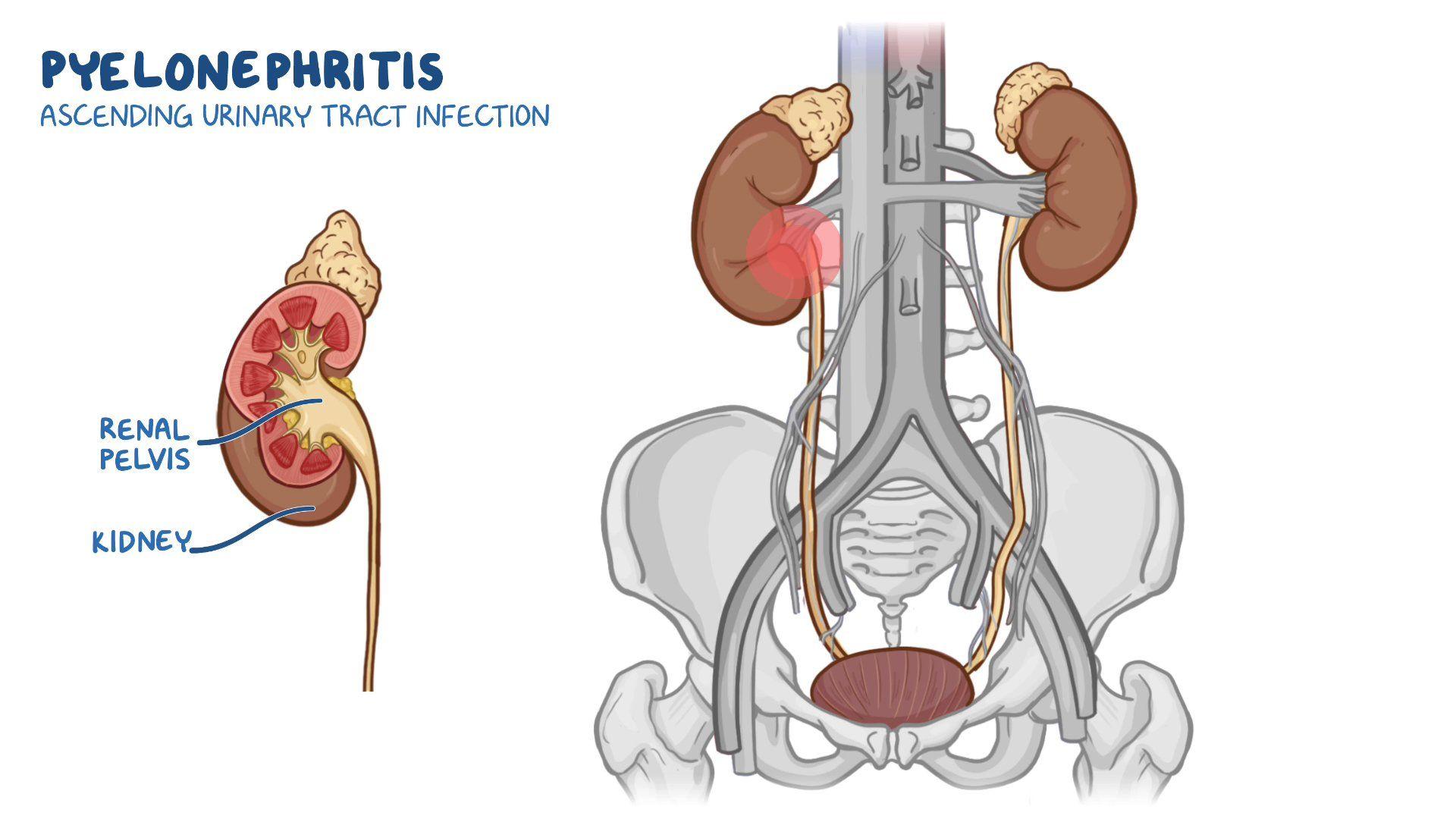 Pyelonephritis: Nursing - Osmosis Video Library