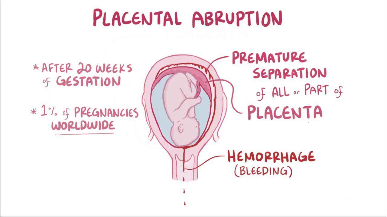 Desprendimiento de placenta: Vídeo & Anatomía | Osmosis