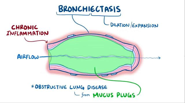 Bronchiectasis: Video, Anatomy, Definition & Function | Osmosis