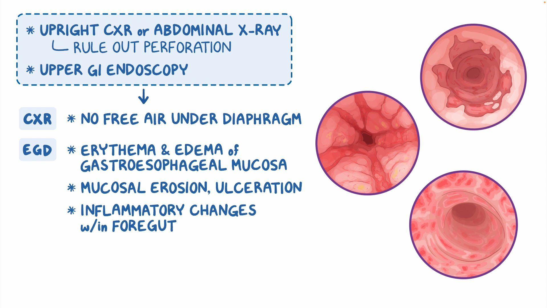 Approach to upper abdominal pain: Clinical sciences - Osmosis Video Library