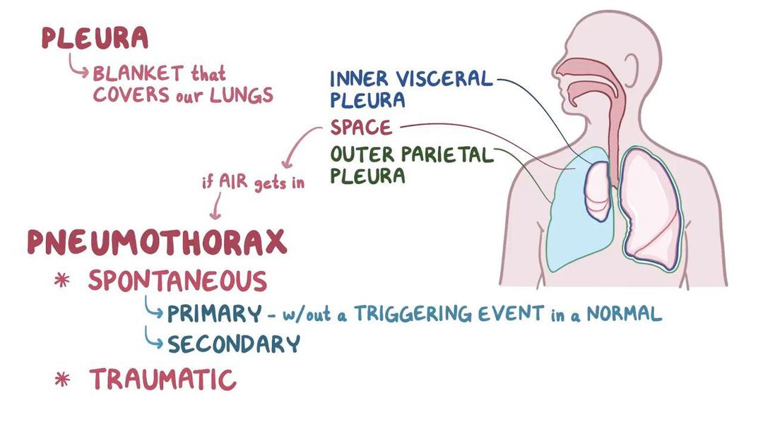 Pneumothorax: Clinical: Video, Anatomy & Definition | Osmosis