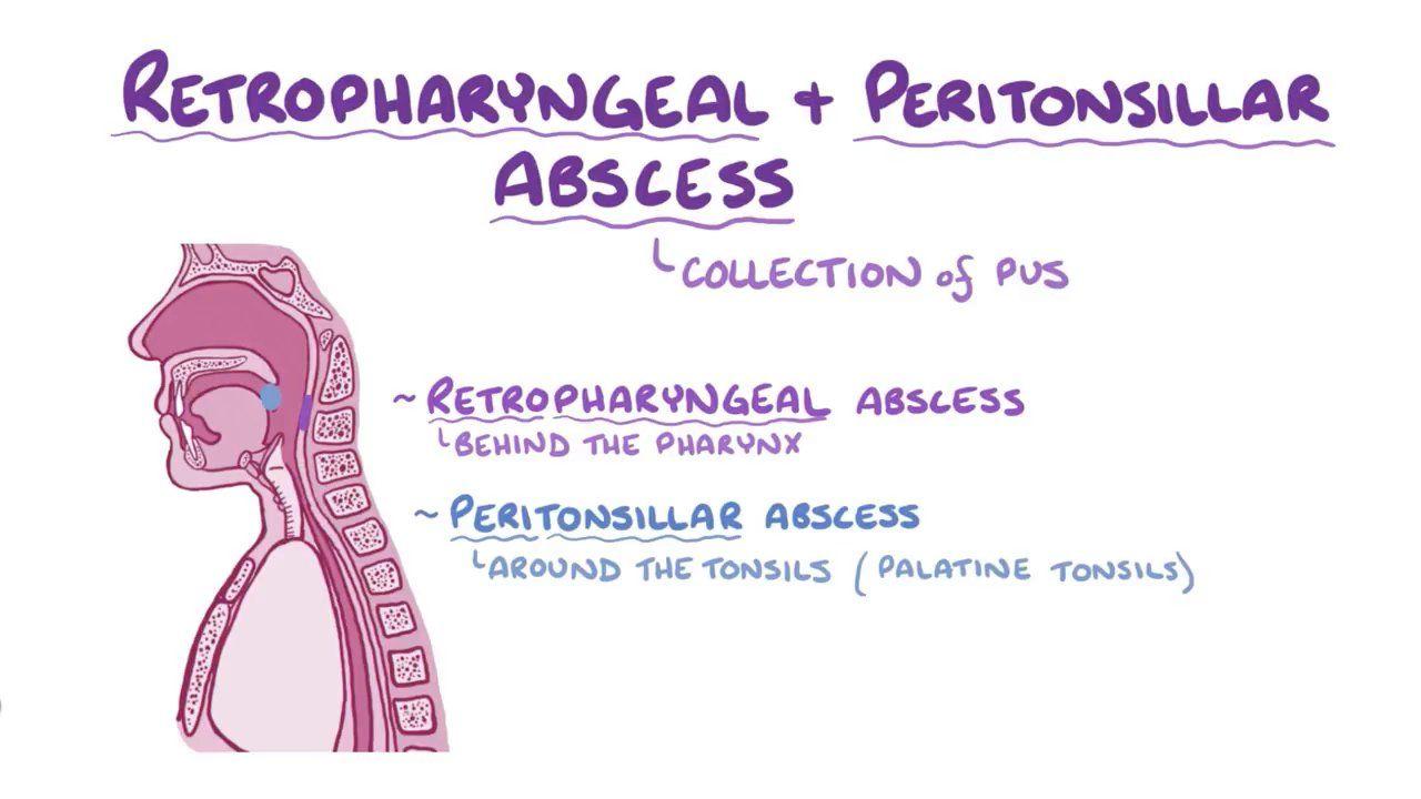 Retropharyngeal and peritonsillar abscesses: Video | Osmosis