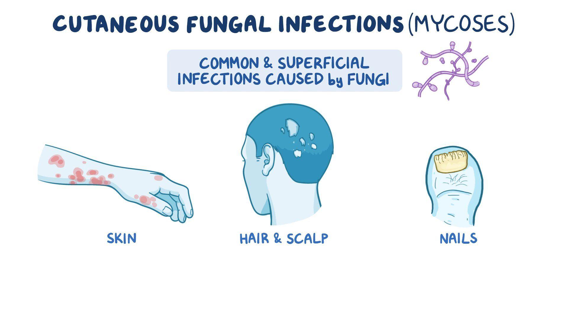 Cutaneous fungal infections: Nursing - Biblioteca de Osmosis