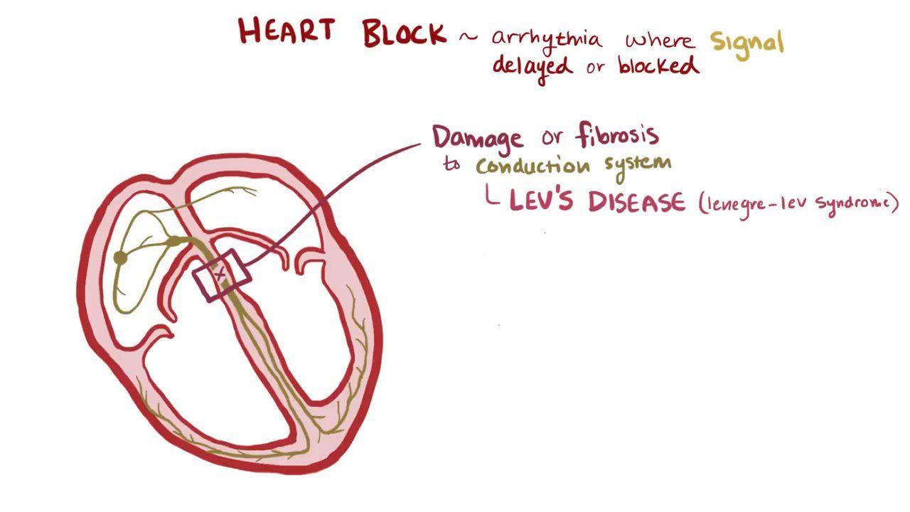 Atrioventricular block: Video, Anatomy & Definition | Osmosis