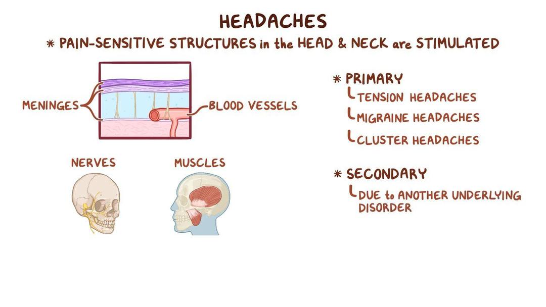 Headaches: Clinical: Video, Anatomy & Definition | Osmosis
