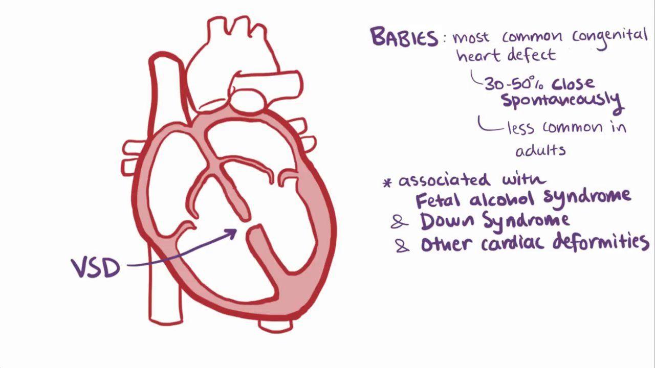 Ventricular septal defect: Video, Anatomy & Definition | Osmosis