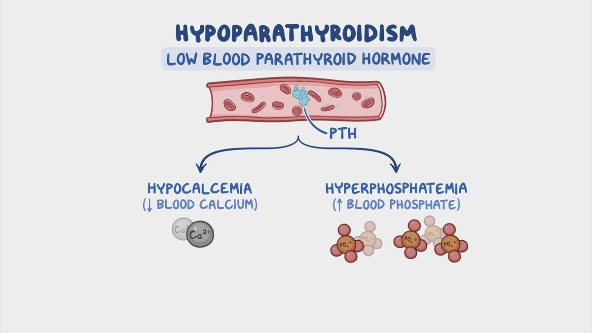 Hypoparathyroidism: Nursing - Osmosis Video Library