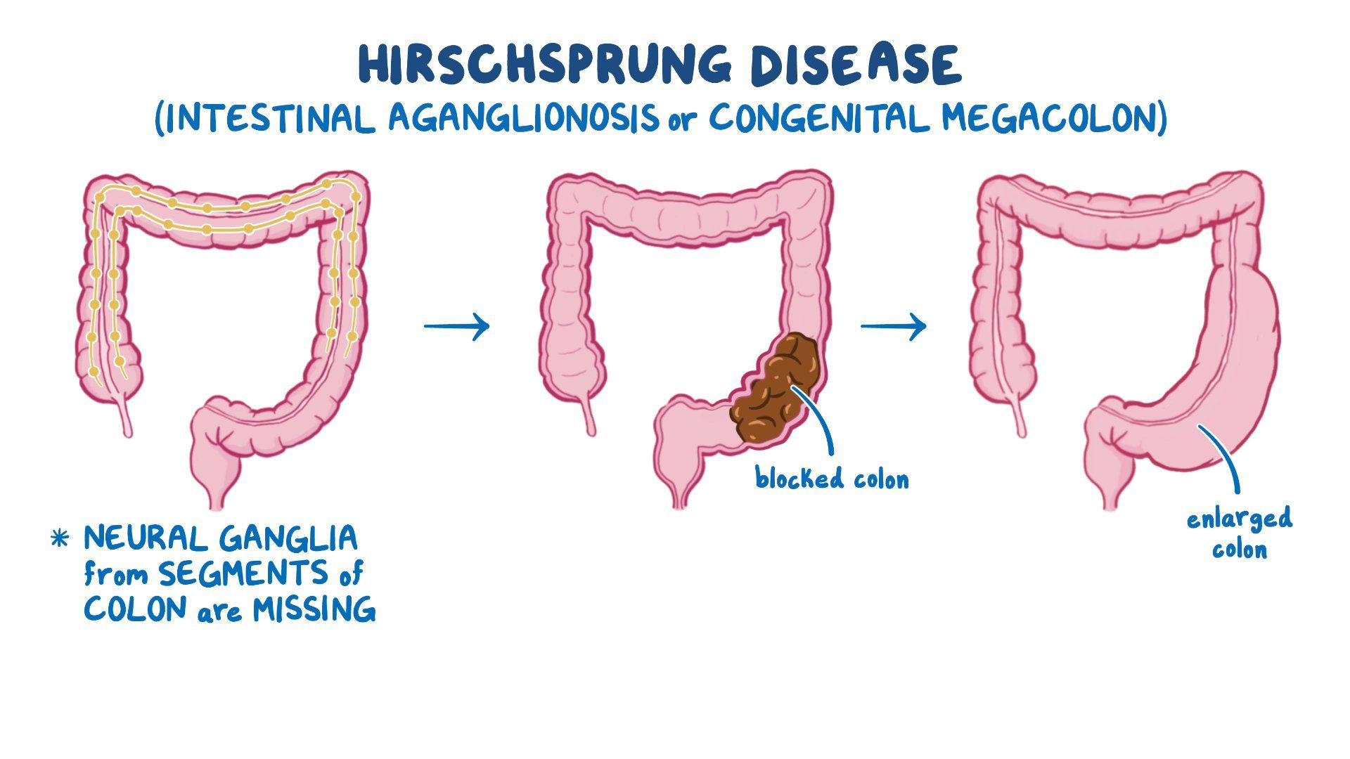 Hirschsprung disease: Nursing - Osmosis Video Library