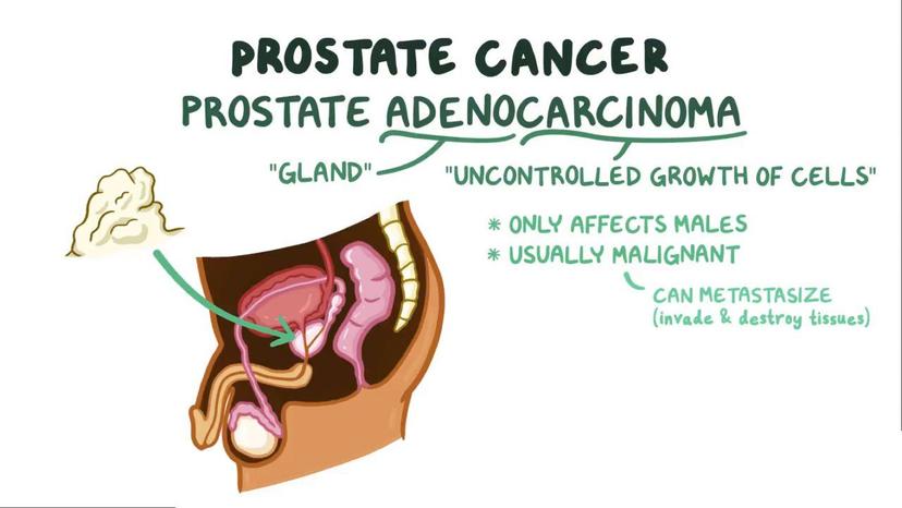 Prostate cancer: Video, Anatomy, Definition & Function | Osmosis
