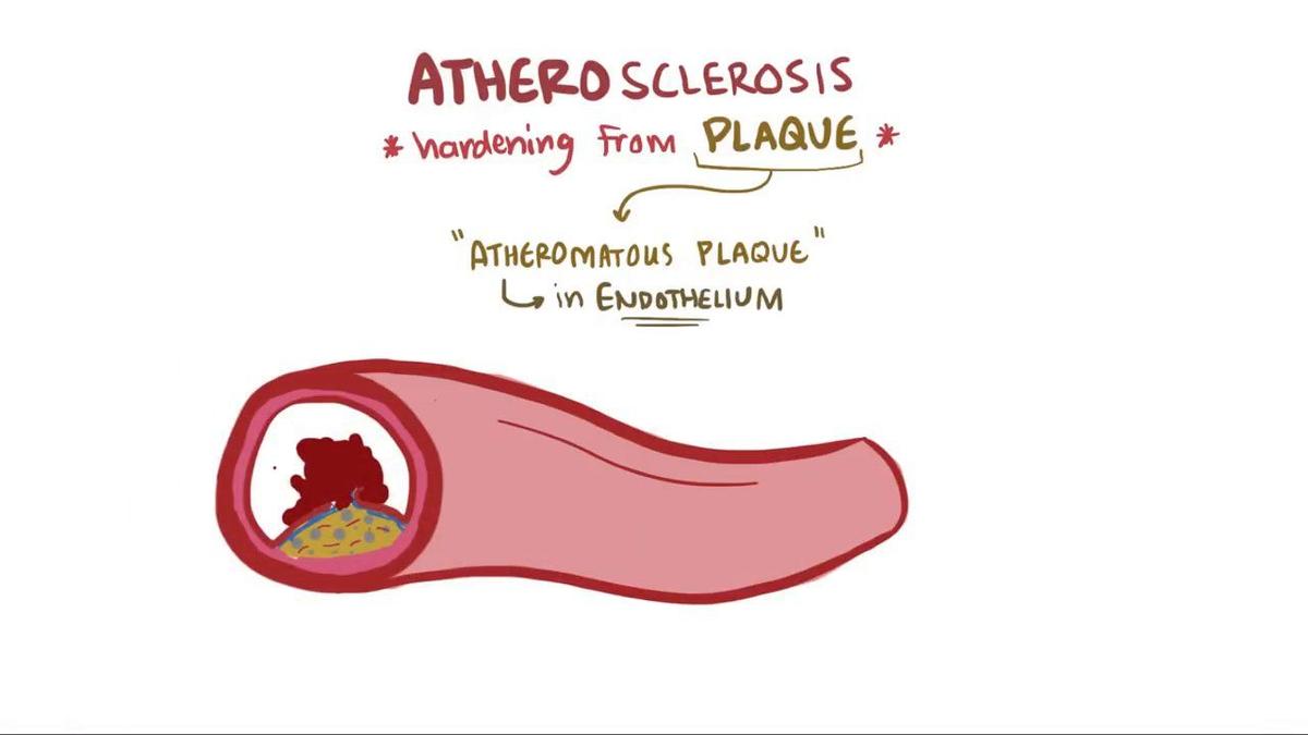 Arterial disease: Video, Anatomy, Definition & Function | Osmosis