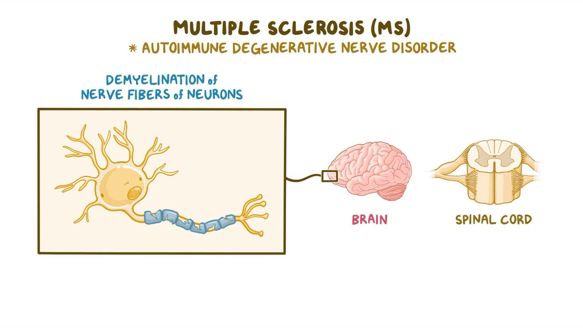 Multiple sclerosis (MS): Nursing - Osmosis Video Library
