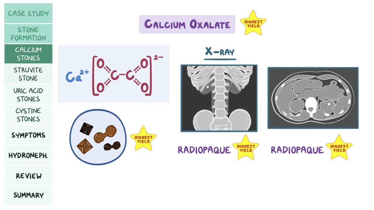 Kidney stones: Pathology review: Video & Anatomy | Osmosis