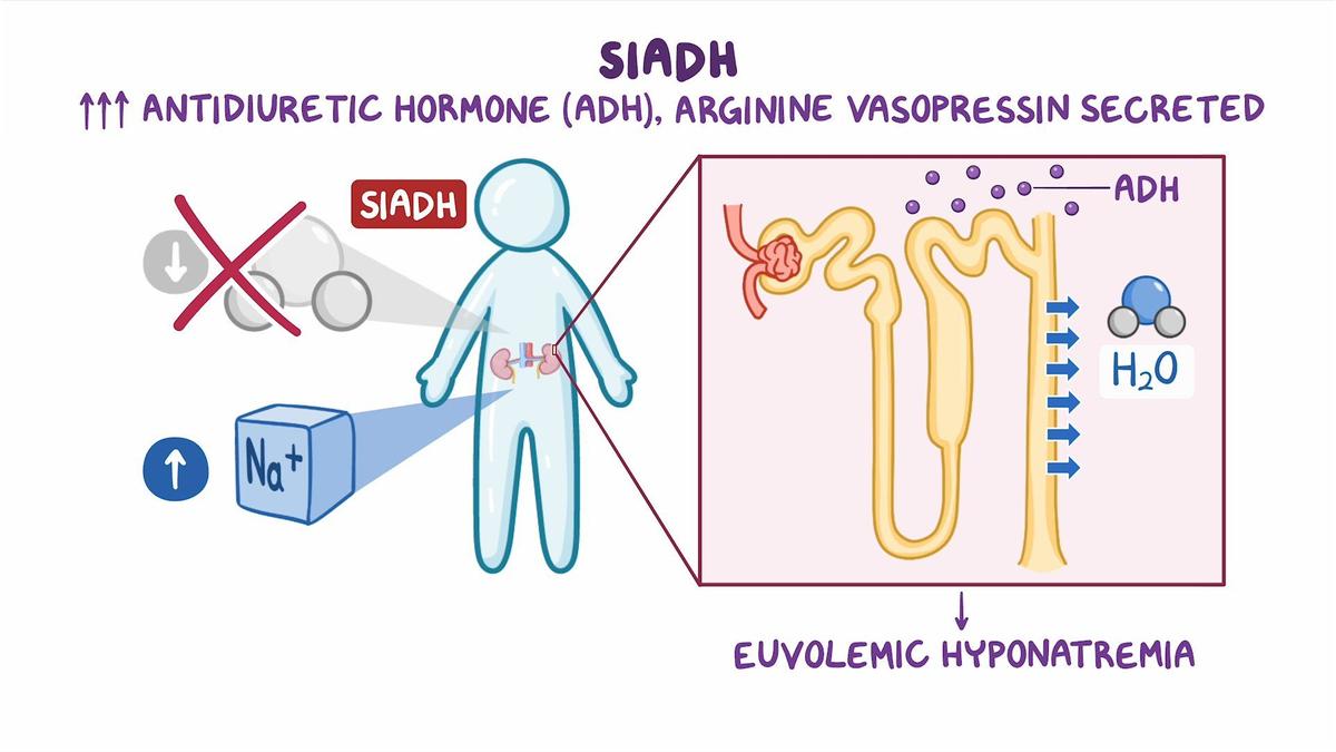 Syndrome of inappropriate antidiuretic hormone secretion: Clinical ...