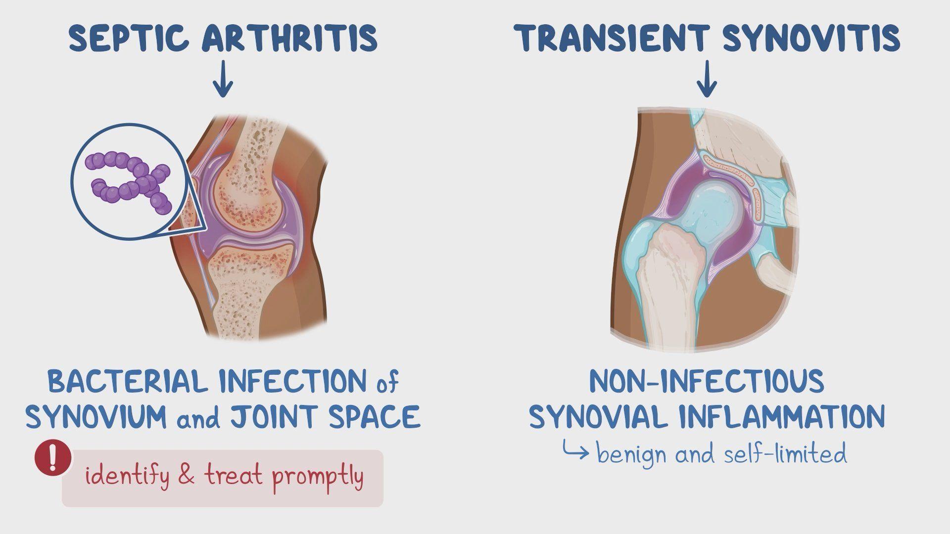 Septic Arthritis And Transient Synovitis pediatrics Video Meaning Septic Arthritis And Transient Synovitis pediatrics Video Meaning