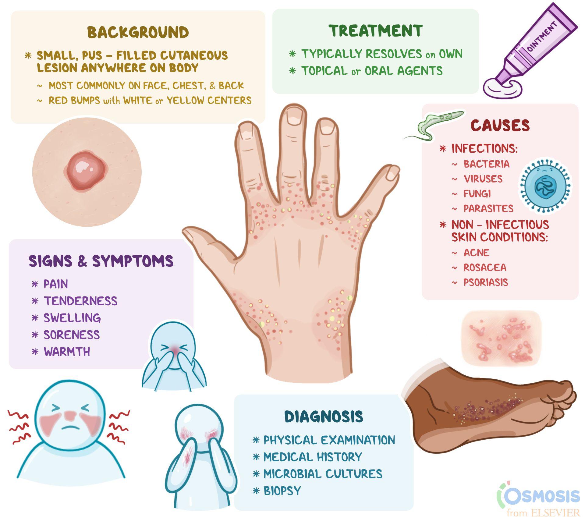 Pustule What Is It Causes Diagnosis Treatment And More Osmosis Pustule What Is It Causes Diagnosis Treatment And More Osmosis