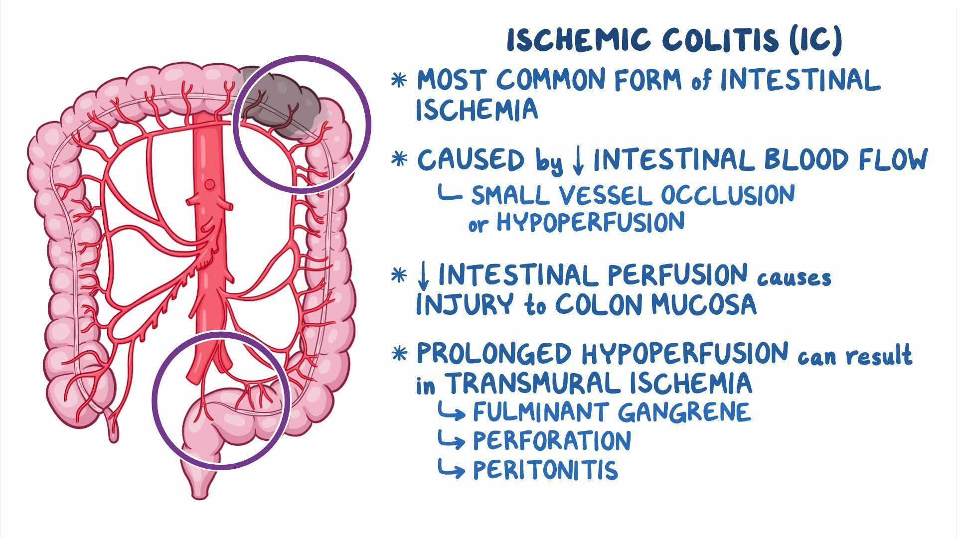Ischemic Colitis Video Meaning Osmosis Ischemic Colitis Video Meaning Osmosis