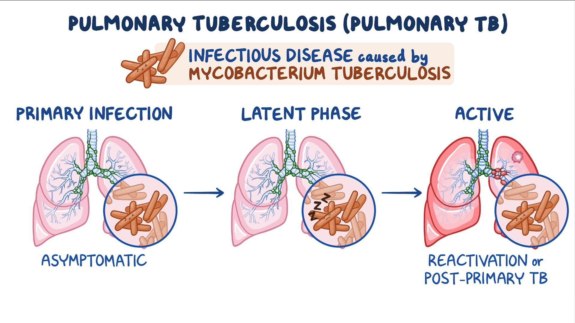 Tuberculosis Meaning Mustak Ahamed On LinkedIn Great News For India s Tuberculosis Meaning Mustak Ahamed On LinkedIn Great News For India s