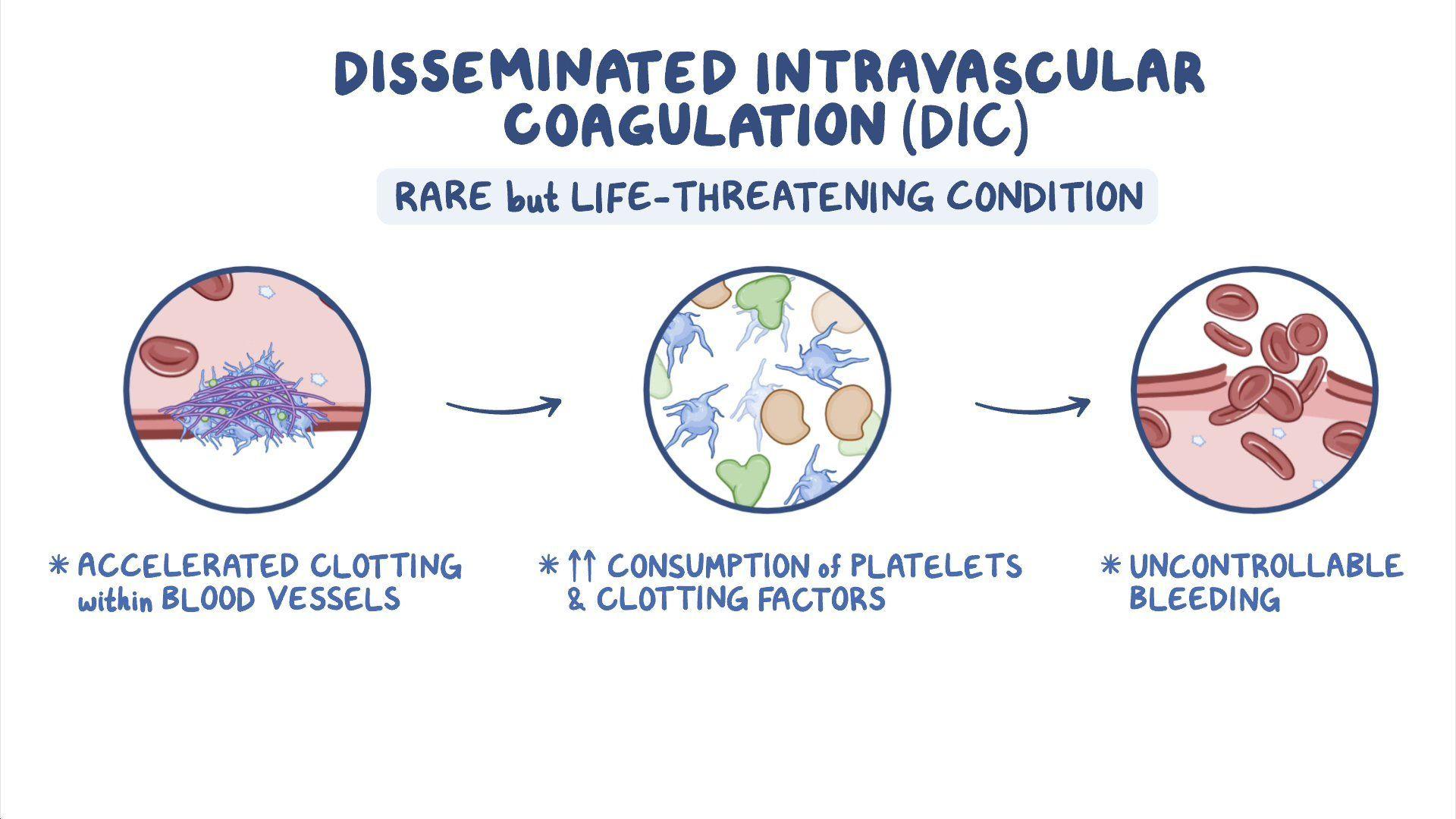 Disseminated Intravascular Coagulation DIC Disseminated Intravascular Disseminated Intravascular Coagulation DIC Disseminated Intravascular