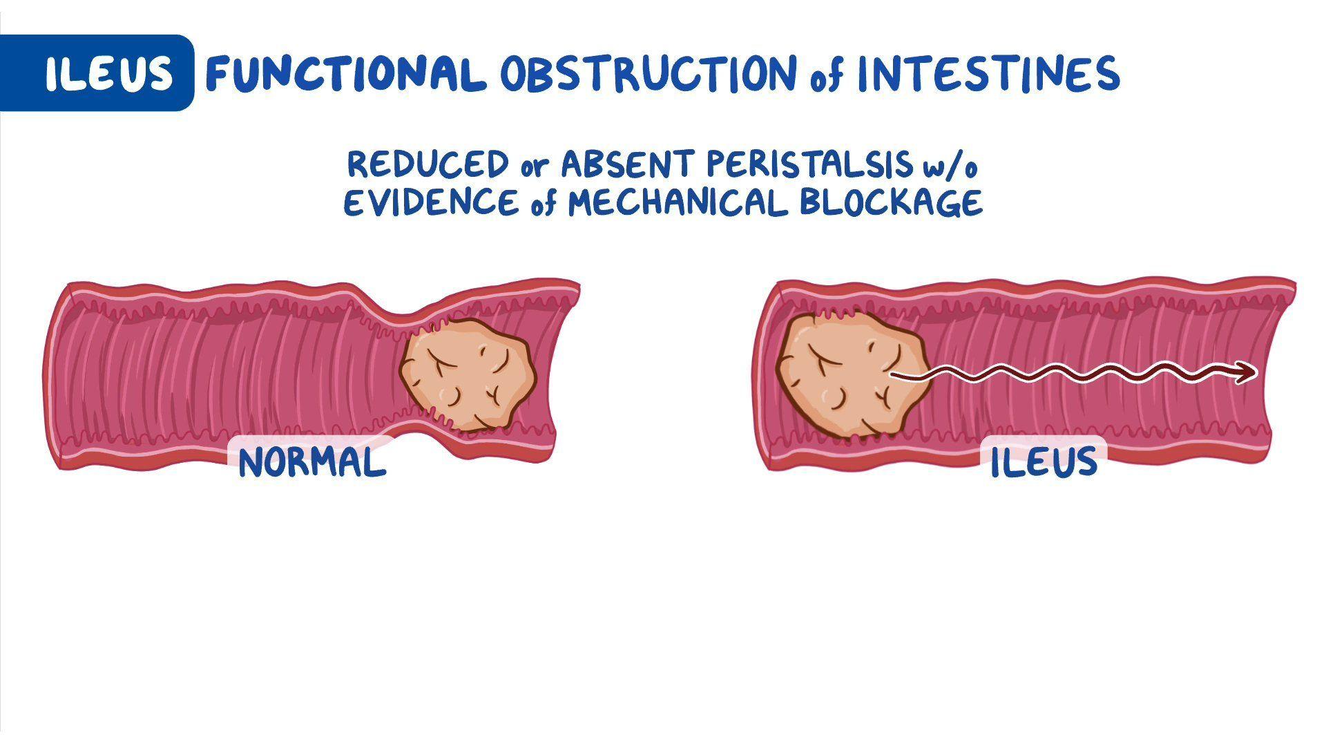 Ileus Video Meaning Osmosis Ileus Video Meaning Osmosis