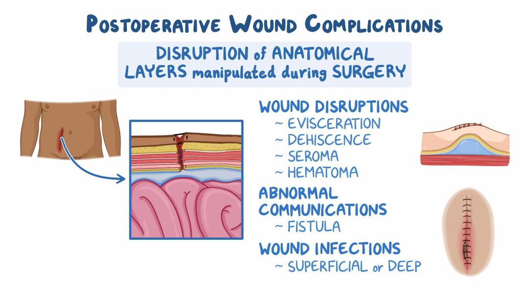 Approach To Postoperative Wound Complications Video Meaning Osmosis Approach To Postoperative Wound Complications Video Meaning Osmosis