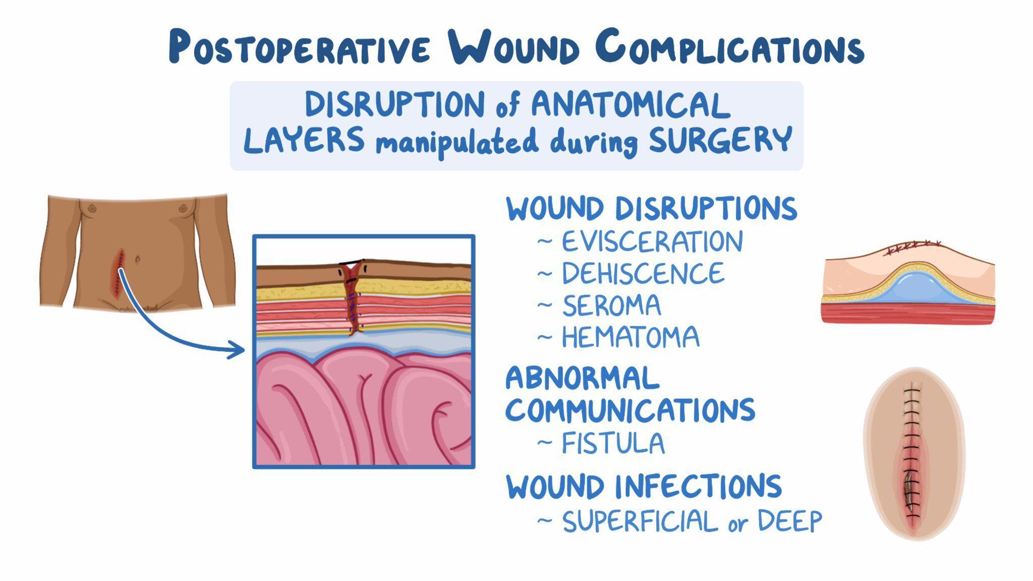 Approach To Postoperative Wound Complications Video Meaning Osmosis Approach To Postoperative Wound Complications Video Meaning Osmosis