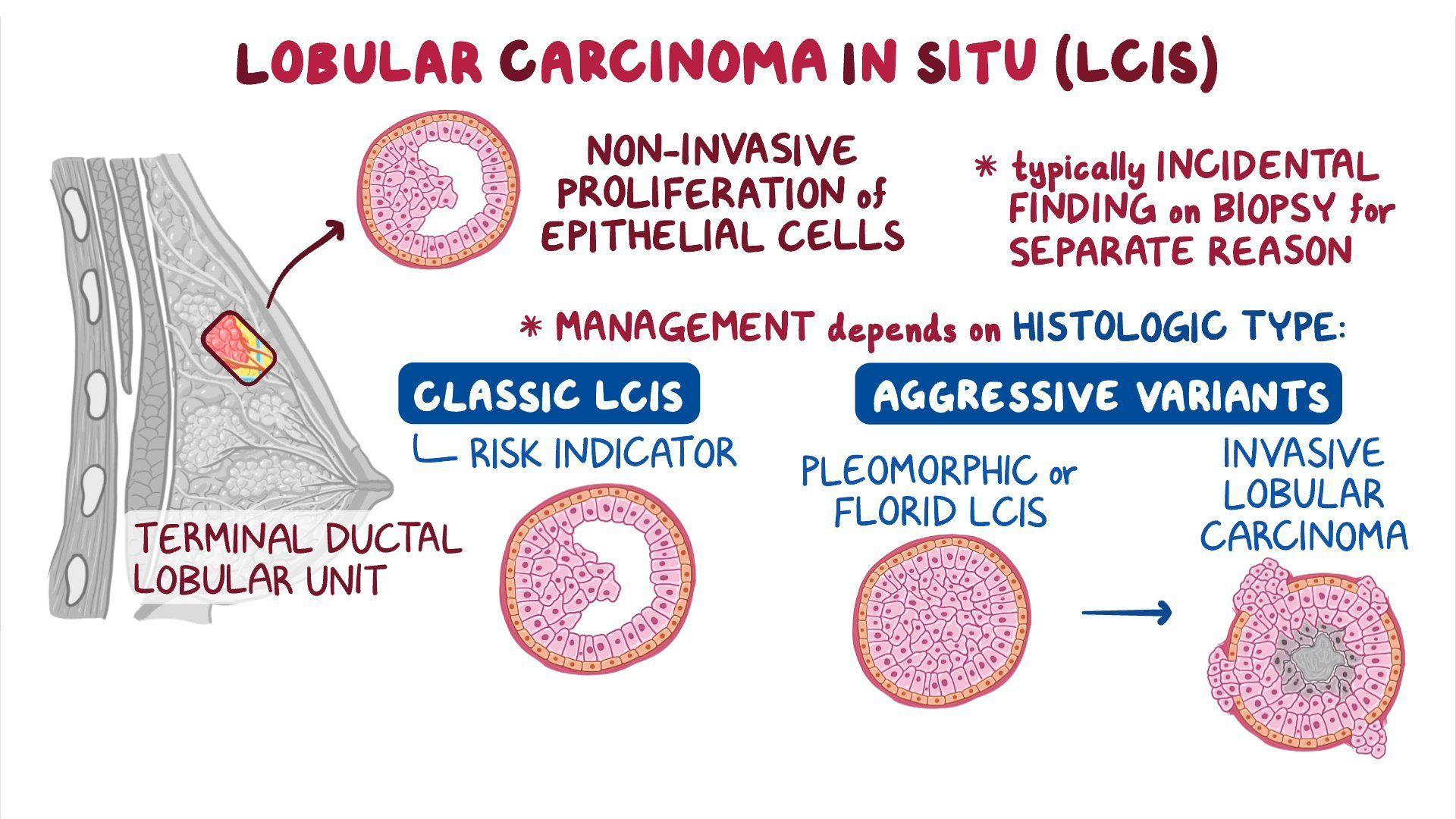 Lobular Carcinoma In Situ Video Meaning Osmosis Lobular Carcinoma In Situ Video Meaning Osmosis
