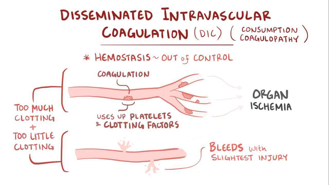 Disseminated Intravascular Coagulation DIC Disseminated Intravascular Disseminated Intravascular Coagulation DIC Disseminated Intravascular