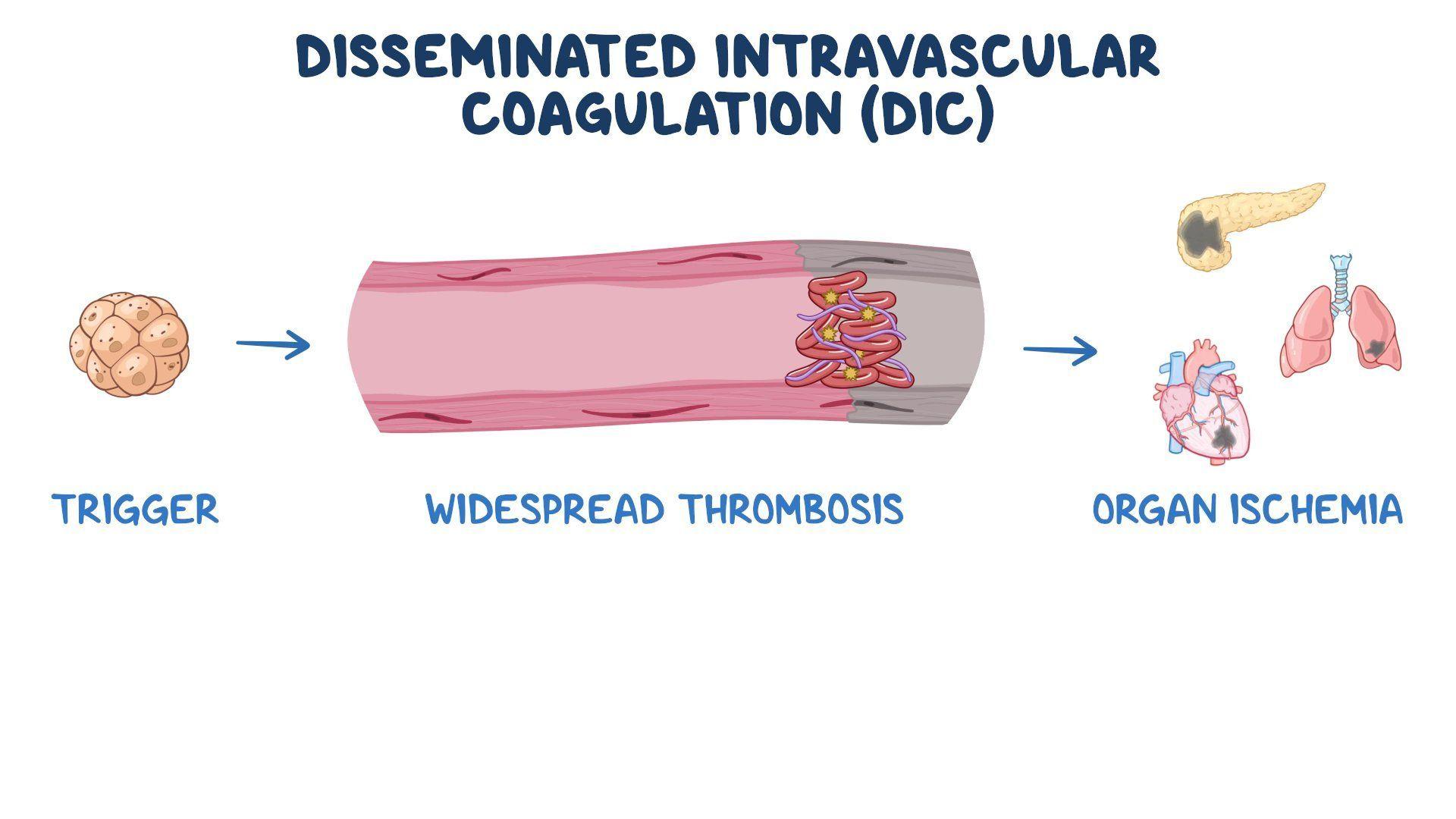 Coagulaci n Intravascular Diseminada Ciencias Cl nicas Osmosis Coagulaci n Intravascular Diseminada Ciencias Cl nicas Osmosis