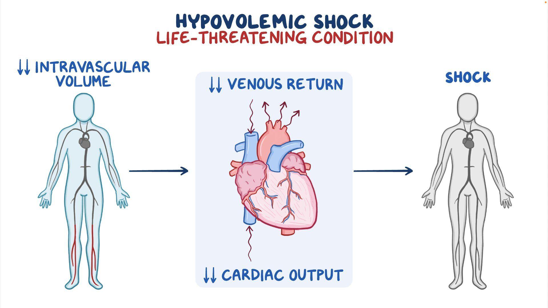 Hypovolemic Shock Clinical Sciences Osmosis Video Library Hypovolemic Shock Clinical Sciences Osmosis Video Library