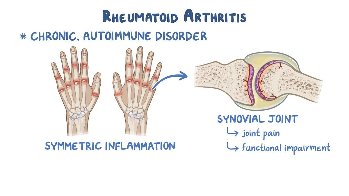 Rheumatoid Arthritis Clinical Sciences Osmosis Video Library Rheumatoid Arthritis Clinical Sciences Osmosis Video Library