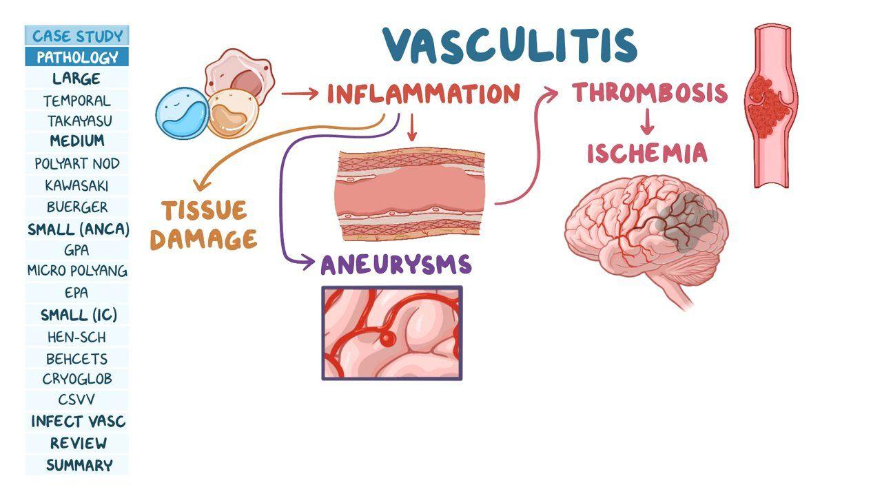 Vasculitis Pathology Review Video Anatomy Osmosis Vasculitis Pathology Review Video Anatomy Osmosis