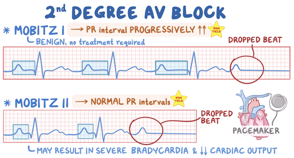 USMLE® Step 2 CK Question of the Day: Second Degree Mobitz type II AV ...